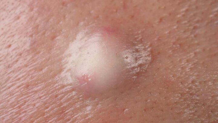 Managing Skin Infections & Abscesses: How Urgent Care Can Help