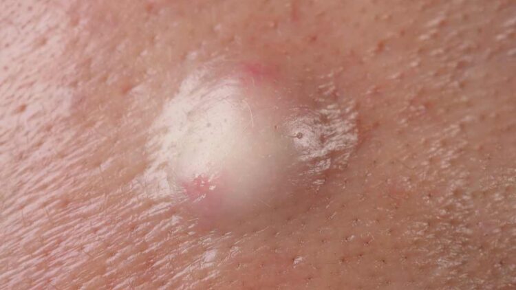 Managing Skin Infections & Abscesses: How Urgent Care Can Help