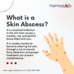 Abscess Drainage: When to Visit Urgent Care for a Skin Abscess