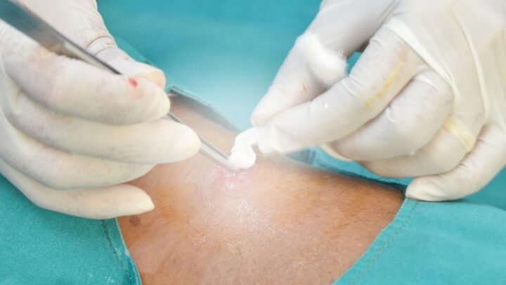 Abscess Drainage: When to Visit Urgent Care for a Skin Abscess